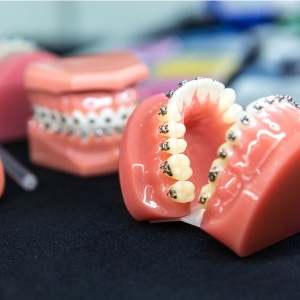 TIPOS DE ORTODONCIA - Clínica Dental Nadal - Tu clínica en Palma